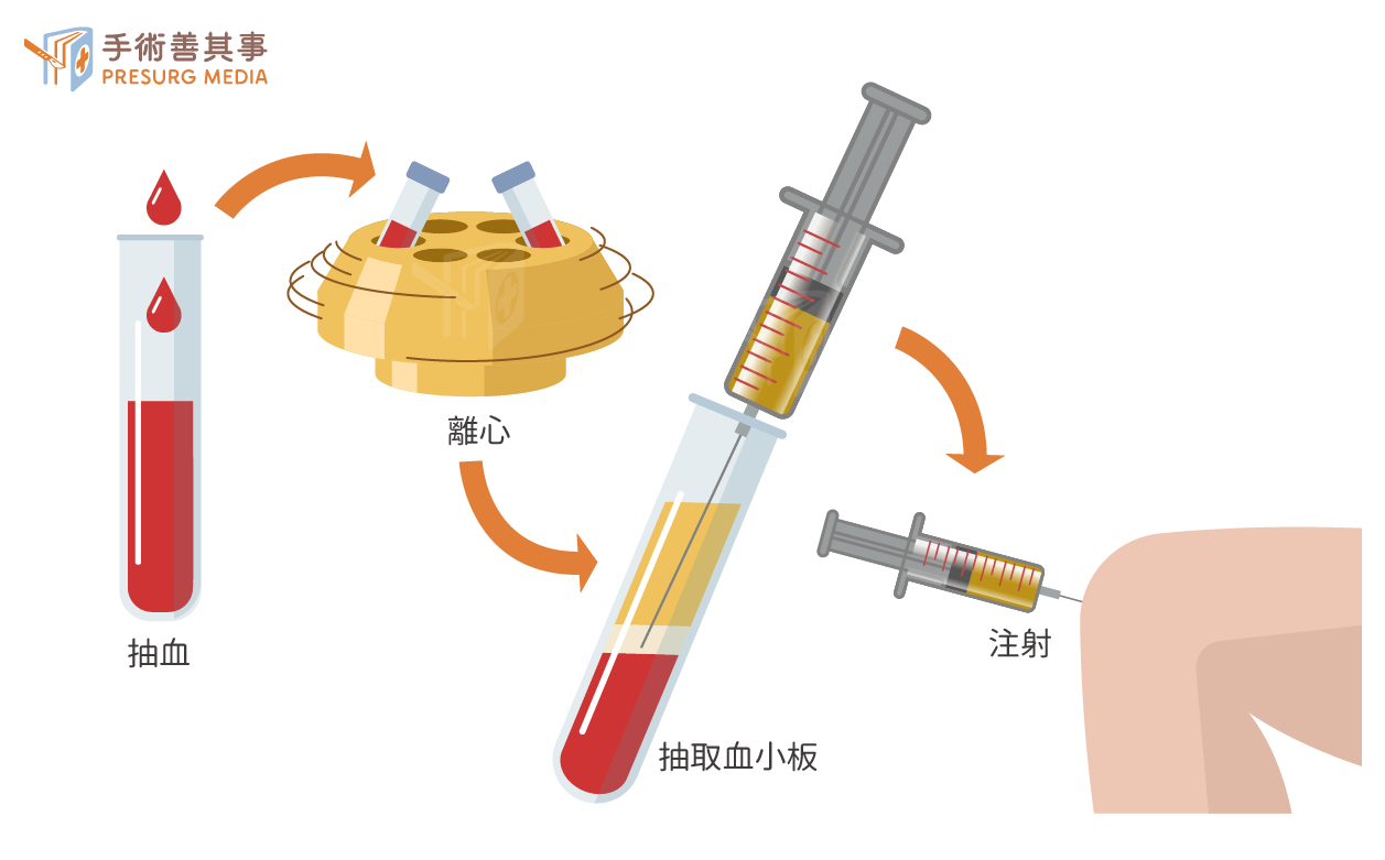 玻尿酸、PRP注射治療關節退化的原理、費用、差異